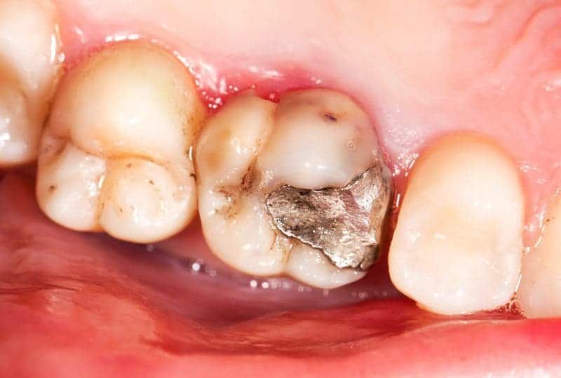 Dental Mercury: Should It Be Banned? - DentalSave Dental Plans