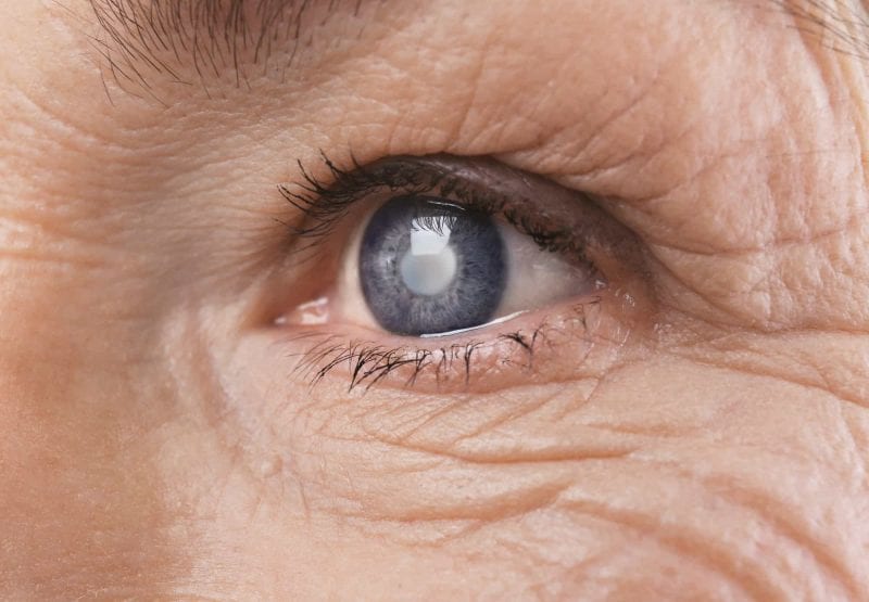 Understanding Cataracts | The Clouding of the Eye’s Lens
